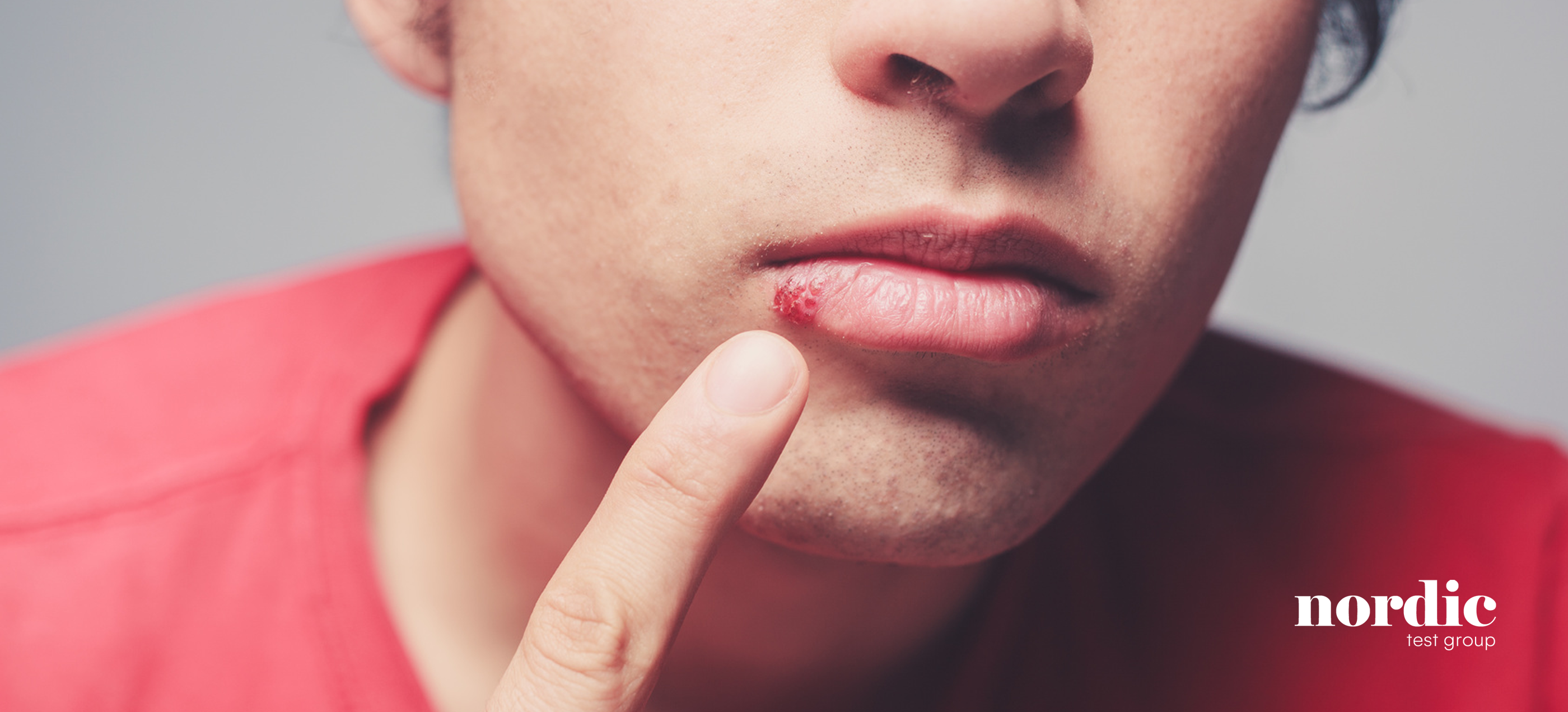 Testează -te pentru herpes cu nortest: herpesta și herpes proba de sânge